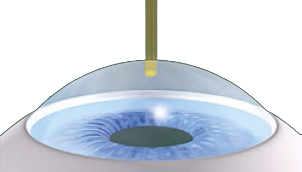 Trans-PRK Augenlaser - Augenlaserklinik Saar