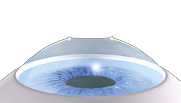 Trans-PRK Augenlaser - Augenlaserklinik Saar